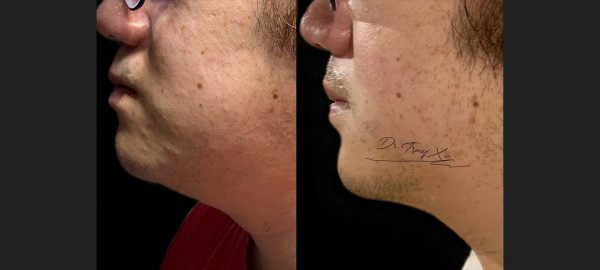 Fat Dissolving – Peonia Medical